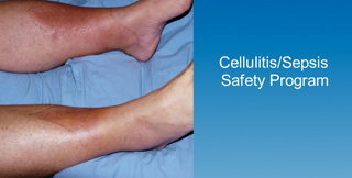Rochester Program for Cellulitis and Sepsis Accuracy