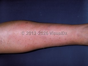 Calciphylaxis