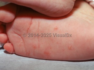 Scabies (pediatric)