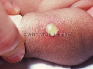 Bullous Impetigo In Children Impetigo: Practice Essentials,