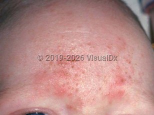 Eosinophilic Pustular Folliculitis Baby Full Article: Noninfectious
