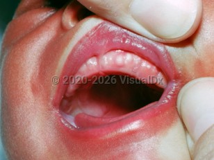 Medical Pictures Info Gingival Cyst