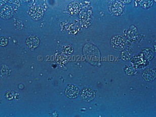 Trichomoniasis