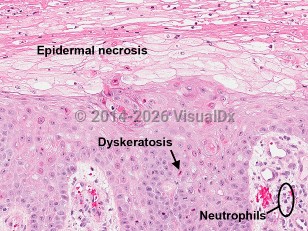 Necrolytic Migratory Erythema Histology Necrolytic Migratory Erythema: