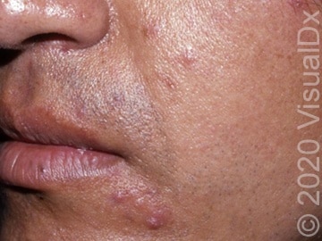 Acne Vulgaris: A Guide to Diagnosis, Treatment, and Management | VisualDx