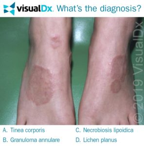 Woman Develops Round, Tender Leg Patches - Let’s Diagnose | VisualDx