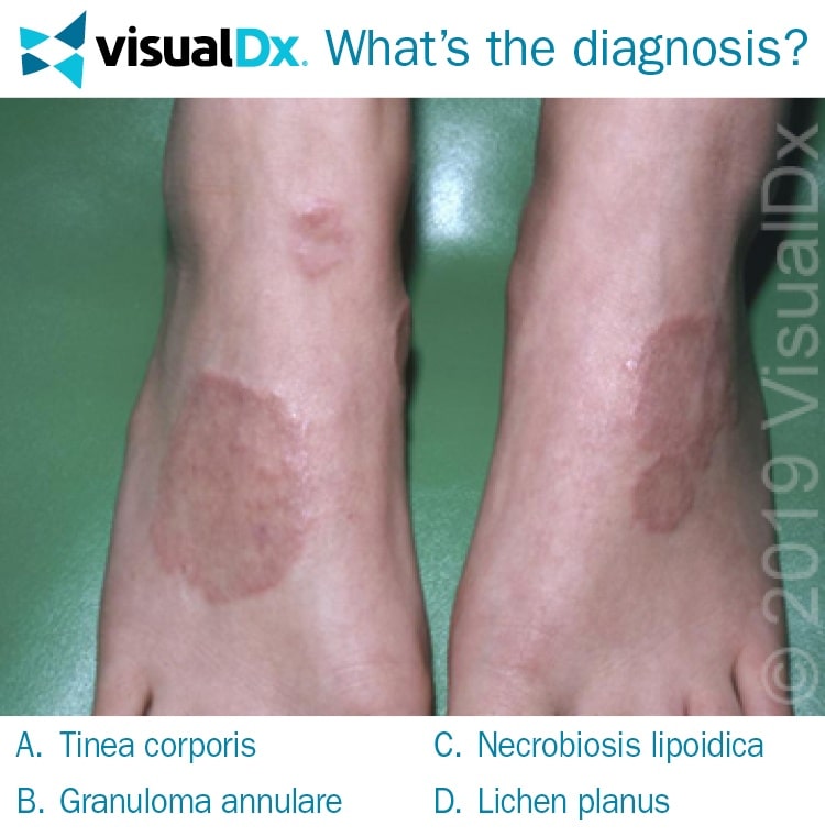 Woman Develops Round, Tender Leg Patches - Let’s Diagnose | VisualDx