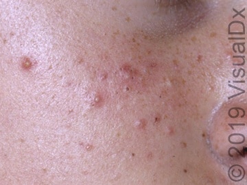 Derm Resident Turns to VisualDx to Search Alternative Acne Treatments ...