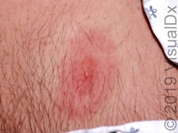 RN Consults VisualDx For Patient’s Drug Reaction Rash To Find It Wasn’t ...