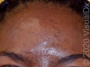 Acne Vulgaris: A Guide to Diagnosis, Treatment, and Management | VisualDx