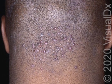 Acne Vulgaris: A Guide to Diagnosis, Treatment, and Management | VisualDx