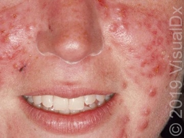 Chief Derm Resident Uses VisualDx for Patient’s Swollen Face, Cheek ...