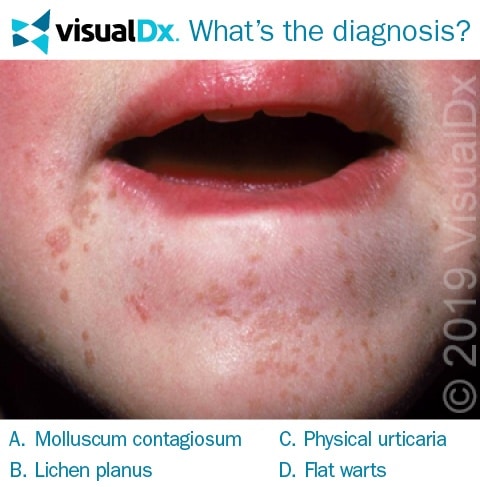 Teen, Treated for Acne, Notices Brown Spots on Chin - Let’s Diagnose ...
