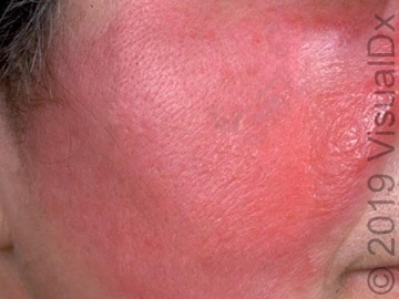 Medical Student Uses VisualDx To Diagnose Patient Cut By Tree Branch ...