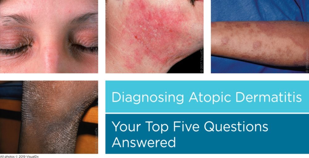 Diagnosing Atopic Dermatitis: Your Top Five Questions Answered | VisualDx