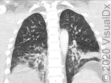 Internal Medicine Physician Makes Early COVID-19 Diagnosis