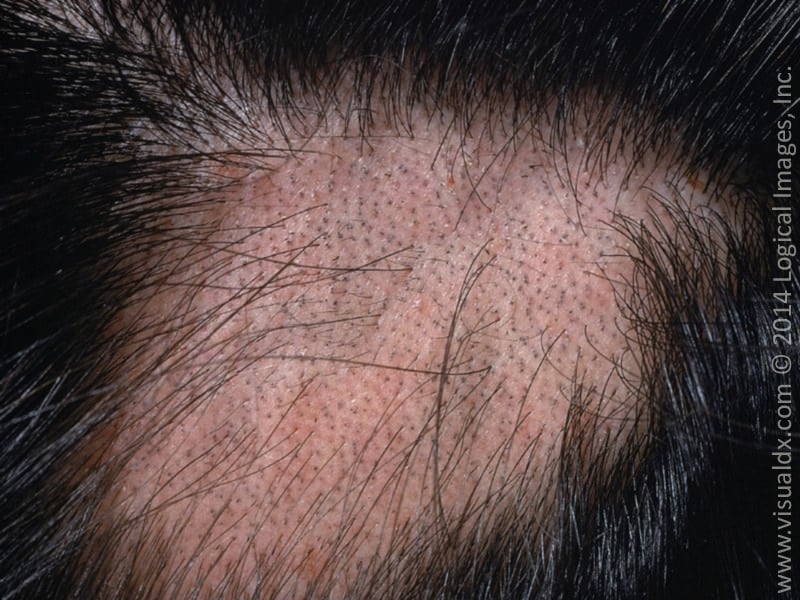 Hair Health and Identity: A Comprehensive Look at Alopecia | VisualDx