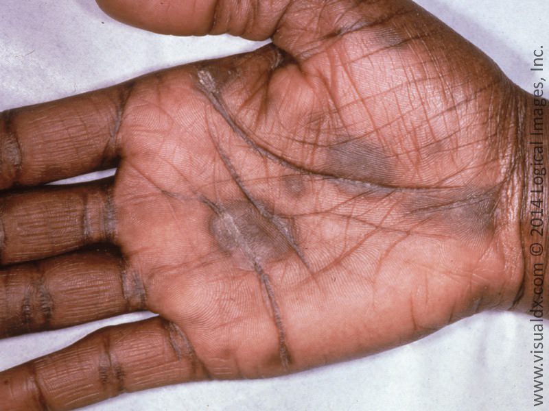 Syphilis Chancre Hand