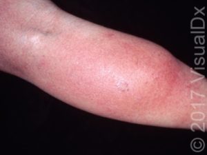 Cellulitis and its Mimickers | VisualDx