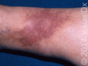 Cellulitis and its Mimickers | VisualDx