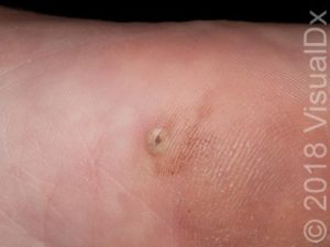 Some travel-related infections are not widely known, leaving patients ...