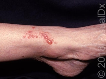 Pharmacy Student Uses VisualDx to Diagnose Family Member’s Rash | VisualDx