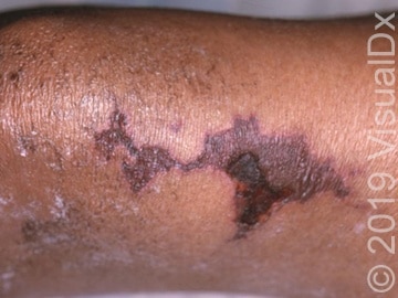 Cornell Derm Resident Investigates Purple Patches with VisualDx | VisualDx