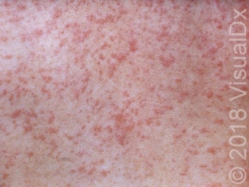 VisualDx Guides Medical Student’s First Time in Pediatric ER | VisualDx