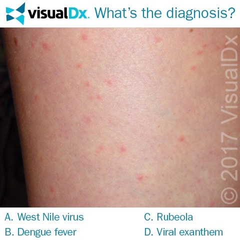 Man Returns from Vermont Trip w/ Illness, Rash - Can You Diagnose ...