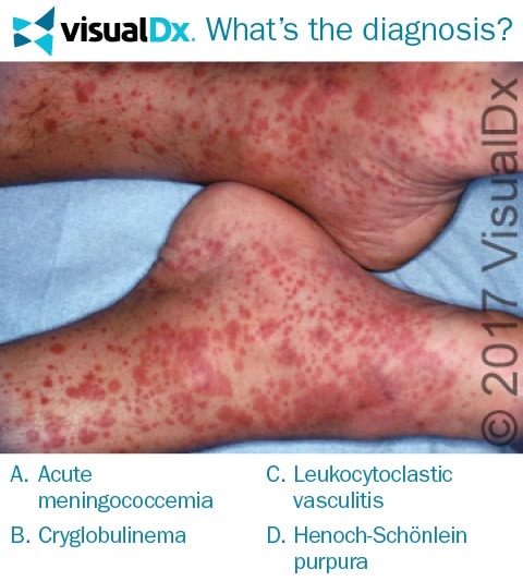 What’s the Diagnosis? - May 8, 2017 | VisualDx