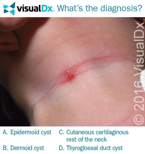 Toddler’s Neck Lesion Has Parents Concerned - Let’s Diagnose | VisualDx