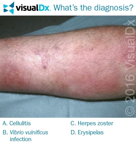 Diabetic Man with Painful Leg Lesion - Let’s Diagnose | VisualDx