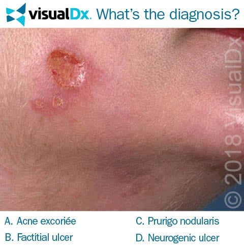Woman’s Face Lesion Causing Her Anxiety - Let’s Diagnose | VisualDx
