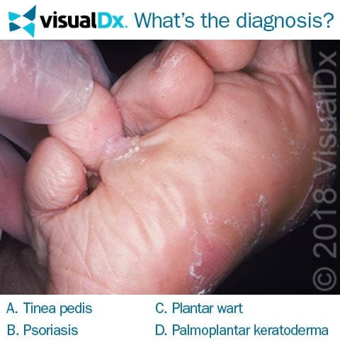 Scaly Plaque on Swimmer’s Feet - Let’s Diagnose | VisualDx