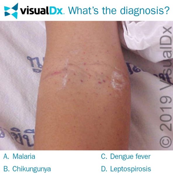 Honeymooner Returns from Jamaica with Chills, Fever, Rash - Let’s ...