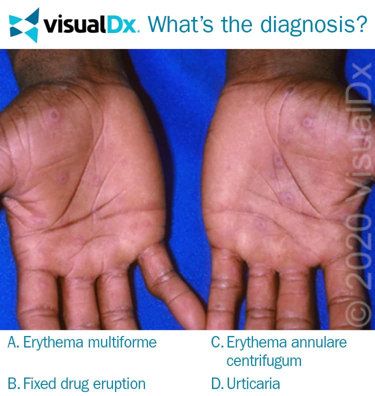 Man Has Targetoid Lesions on Hands, Legs, Arms, Soles - Let’s Diagnose ...