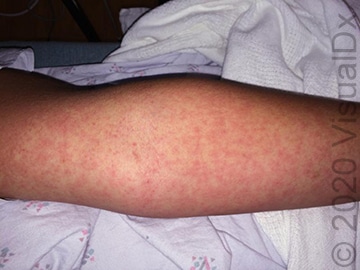 Dermatologic Conditions in Travelers | VisualDx