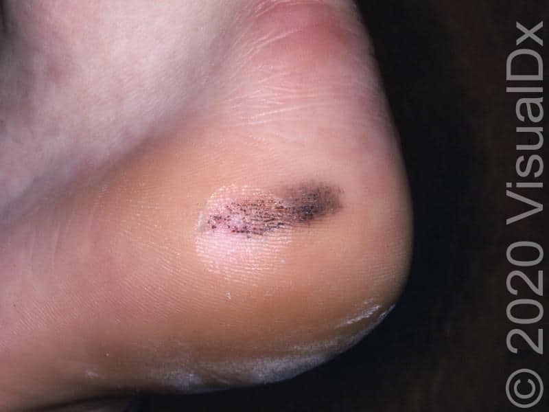 Diagnosing on the Spot: A Guide to Solitary Lesions | VisualDx