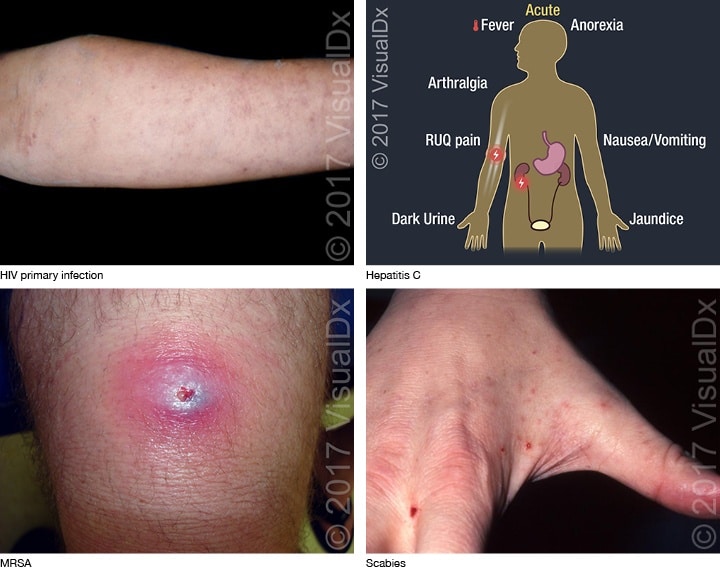 American Prisons: Where Public Health is Most at Risk | VisualDx