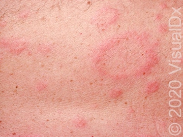 Skin Manifestations of Systemic Diseases | VisualDx