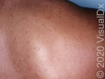 Measles Rash Black Skin Rashes In Babies And Children NHS