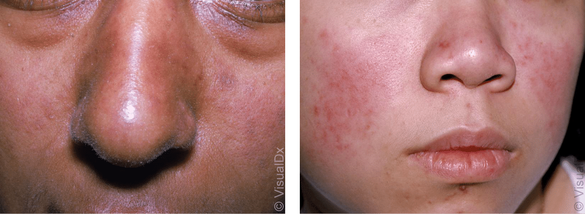 Clinical Decision Support System | VisualDx