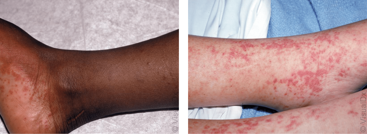 Project IMPACT | Powered by VisualDx