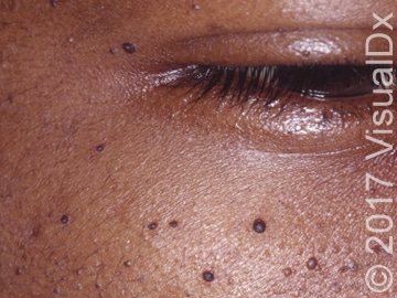 Dermatology Resident Reinforces Diagnostic Decision with VisualDx