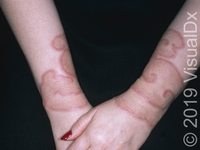 NP Diagnoses Annular Lesion With Help From VisualDx | VisualDx