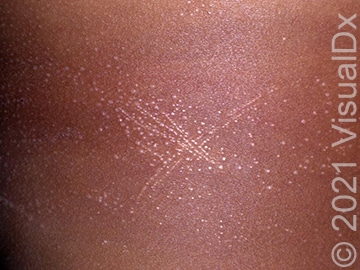 Making Rash Decisions: How Dermatologists Think | VisualDx