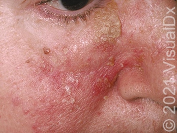 Making Rash Decisions: How Dermatologists Think | VisualDx