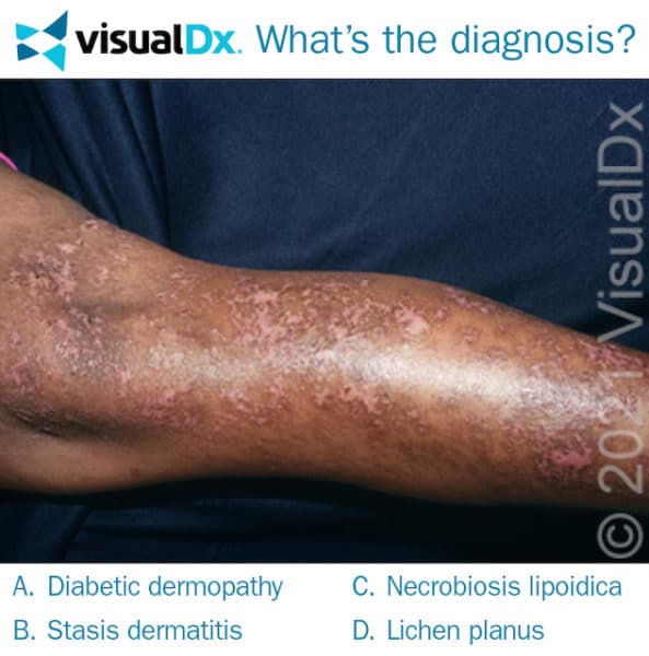 Woman With Diabetes has Atrophic Scars on Shins - Let’s Diagnose