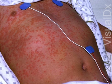 Drug Eruptions: TEN tips to help you adDRESS them | VisualDx