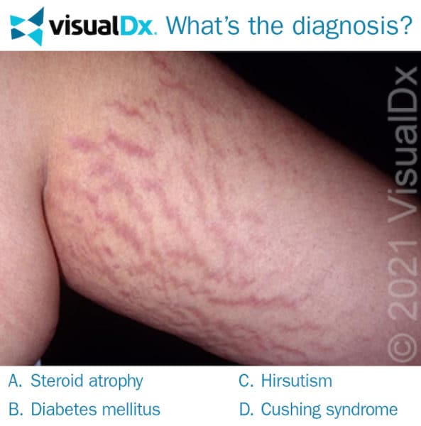 Woman Develops Striae and Telangiectasia - Let’s Diagnose